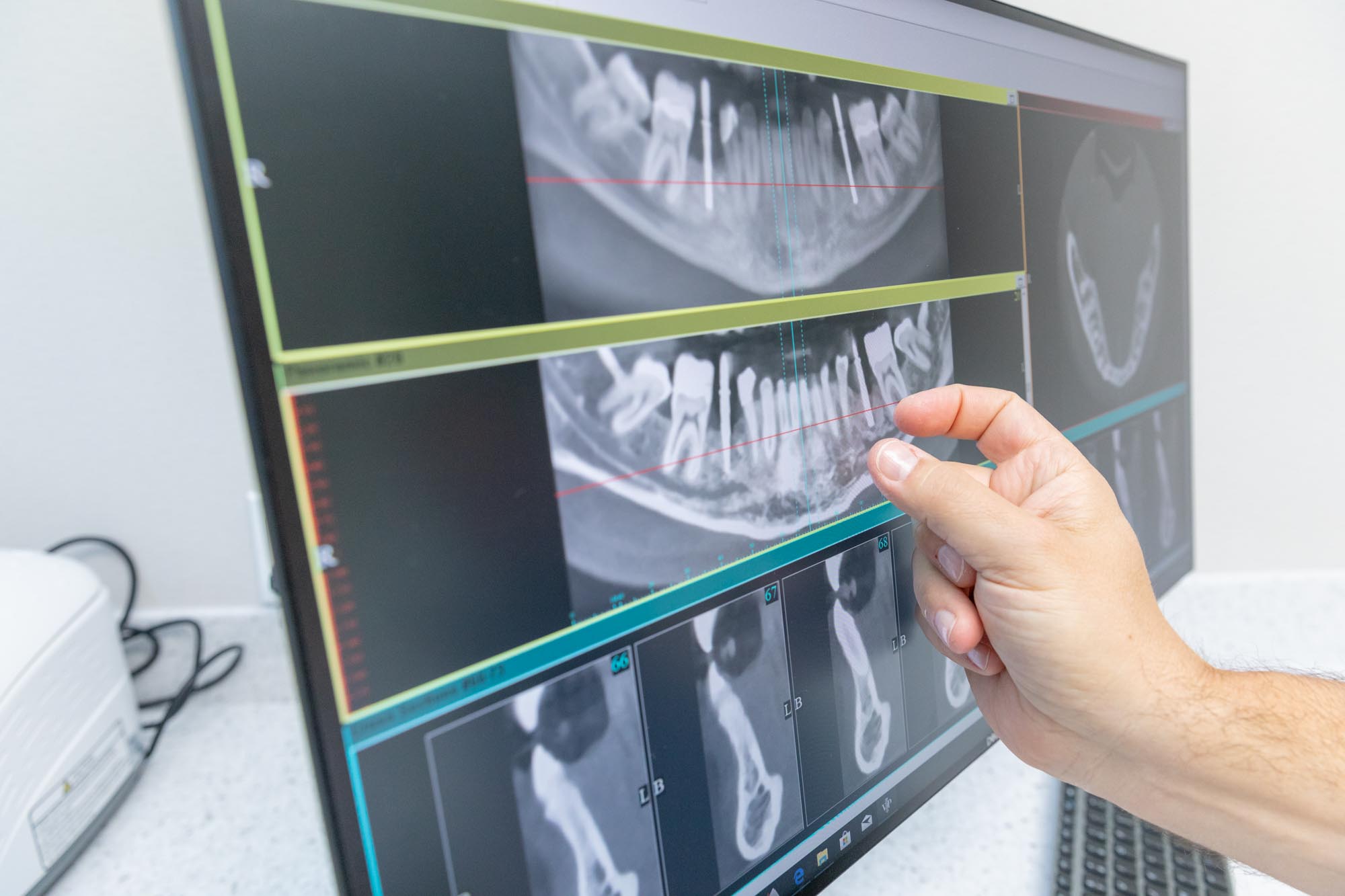 Aesthetic Zone Implants | Cedarhurst, NY