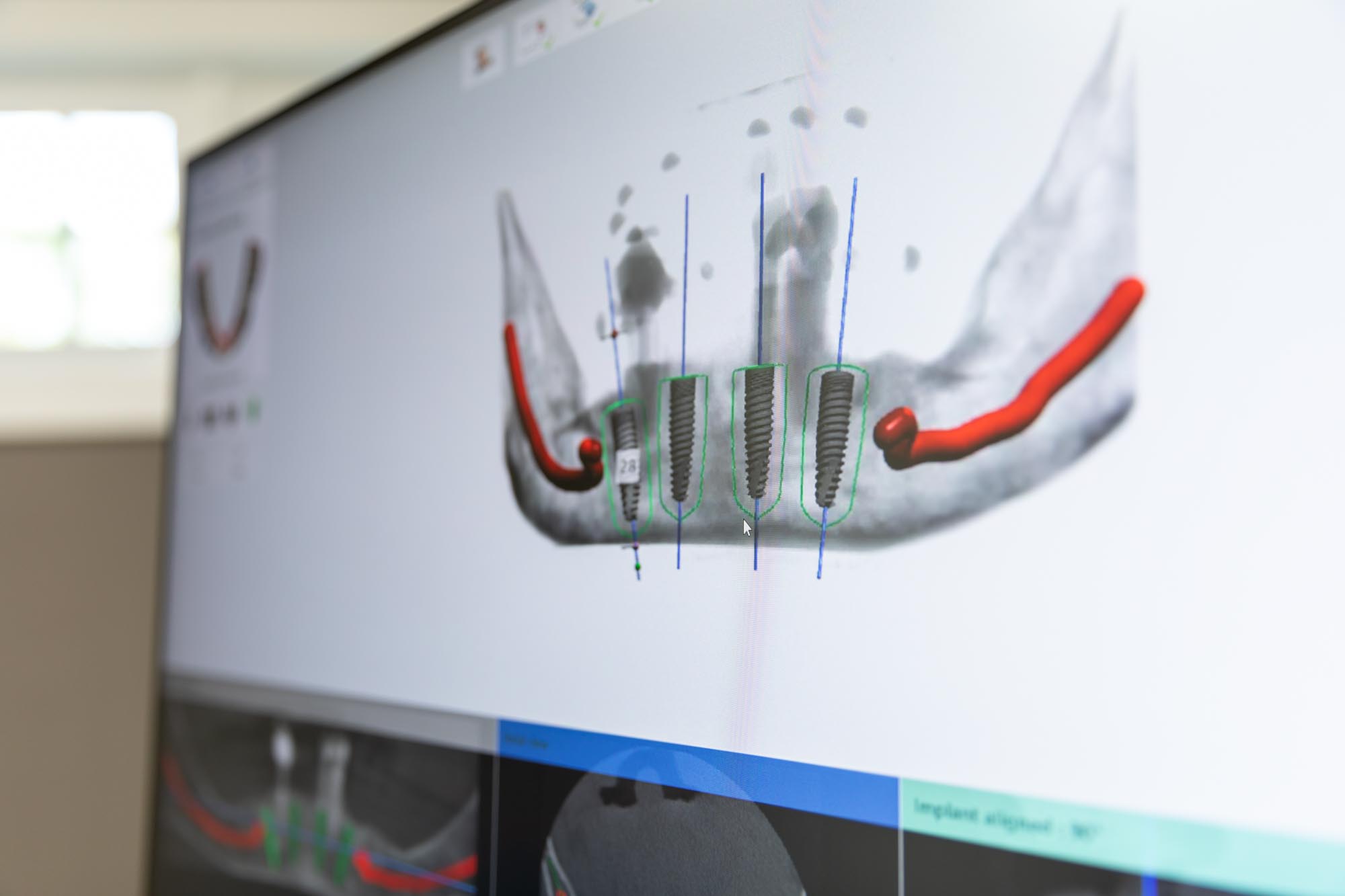 Guided Implant Surgery | Cedarhurst, NY | Implant Placement